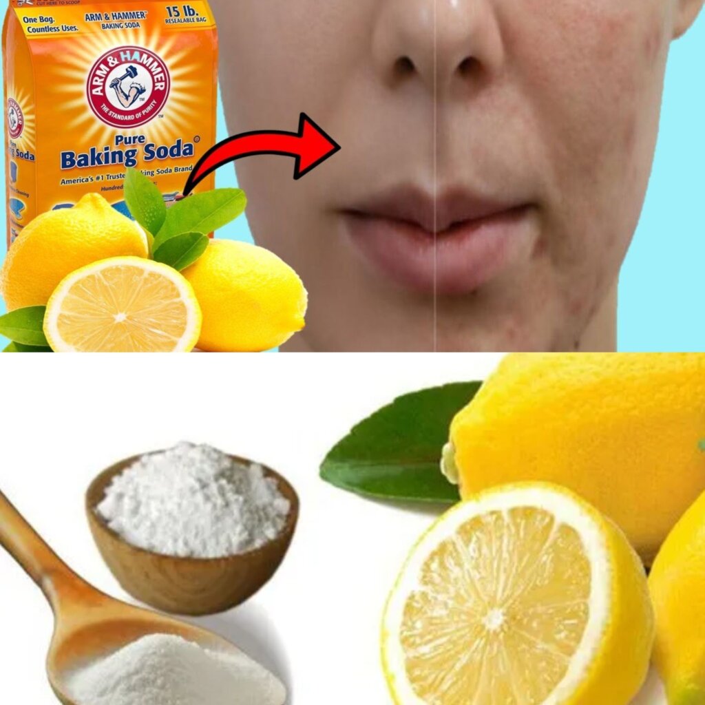 How To Lessen Dark Spots And Acne Scars With Baking Soda And Lemon